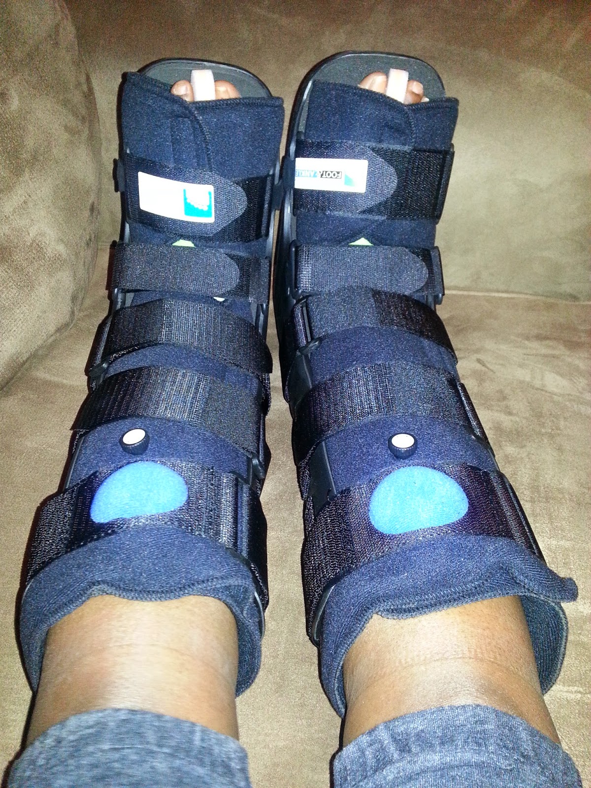 Double Scarf Akin Osteotomy (Bilateral Bunionectomy): Fixing my Feet ...