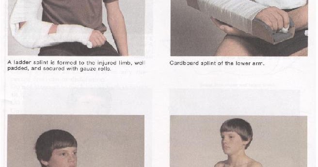 USAHA KESEHATAN SEKOLAH: Tehnik pasang Spalk bidai splint