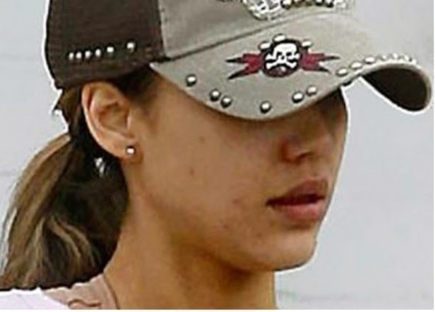 Jessica Alba Acne Image - Acne Picture