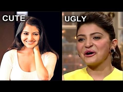 Anushka Sharma Plastic Surgery