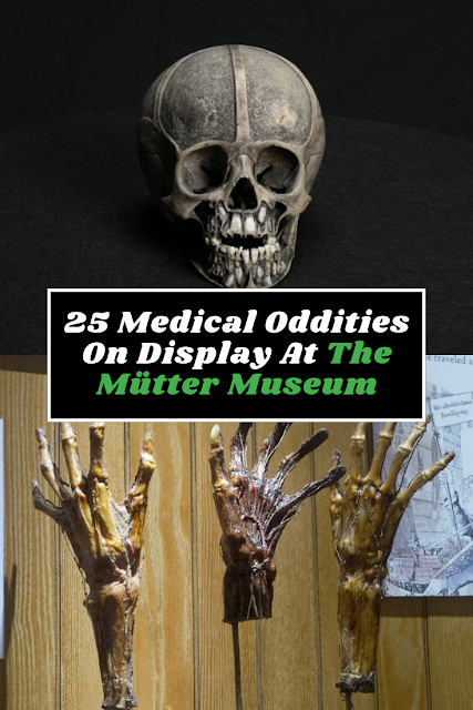 25 Medical Oddities On Display At The Mütter Museum