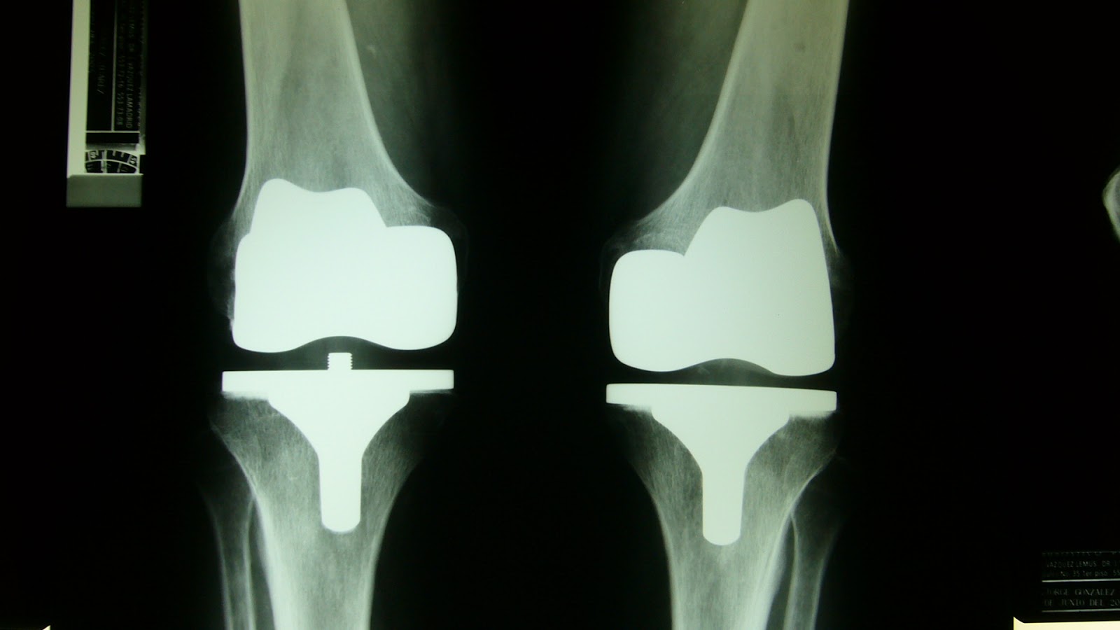 RODILLA Y HOMBRO: PRÓTESIS TOTAL DE RODILLA (ENDOPRÓTESIS O ARTROPLASTIA)