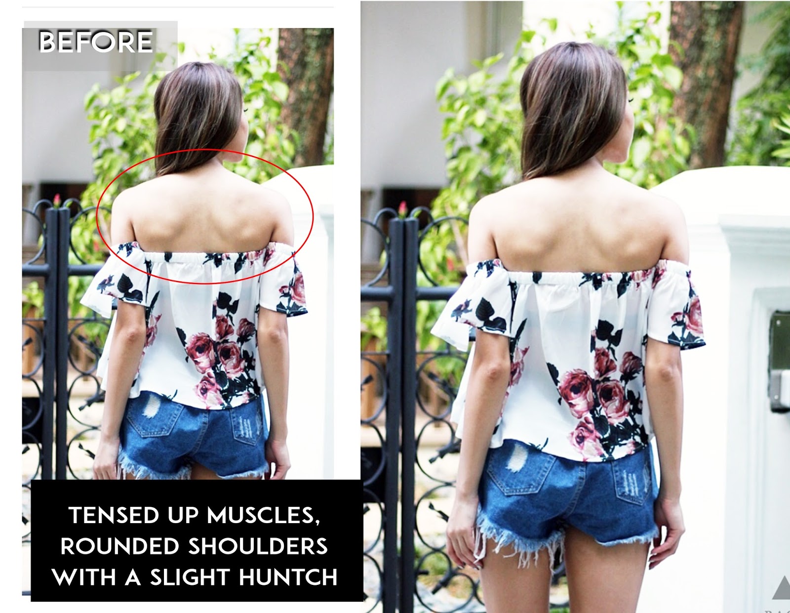 Treating Rounded Shoulders with Acupuncture at PULSE TCM Clinic - MONGABONG