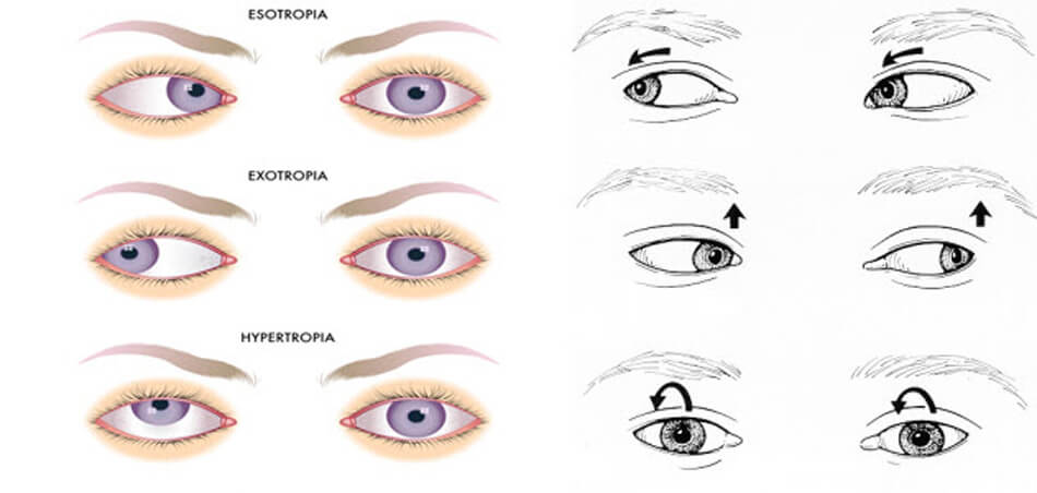Types Of Nystagmus Ppt - Design Talk