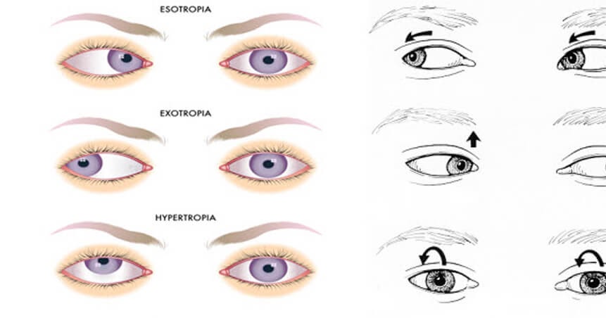 Nystagmus definition, causes, diagnosis,types, investigations