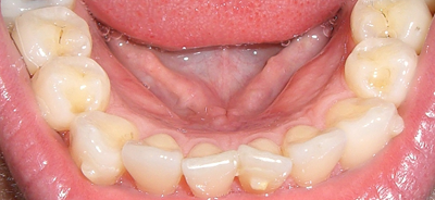 Sneek's Invisalign Treatment: Progress Weeks 17-18