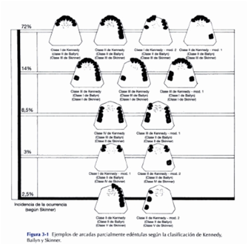 Evaluación de Diente Pilar y Áreas Edéntulas: Clasificación de Kennedy