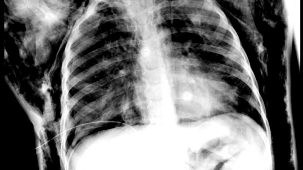 Subcutaneous emphysema