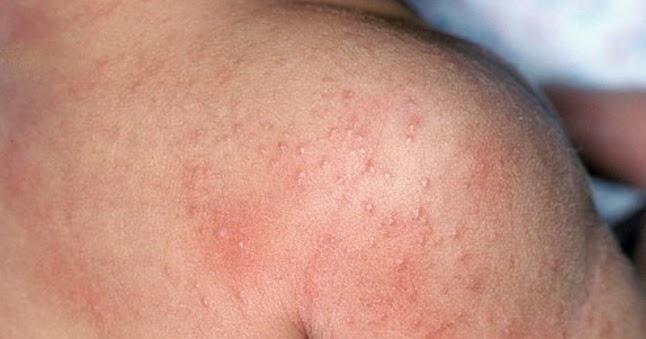 How To Get Rid Of A Rash Fast: How you can Eliminate Rashes Naturally ...