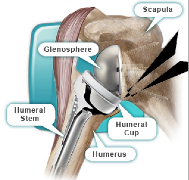 Shoulder Arthritis / Rotator Cuff Tears: causes of shoulder pain ...