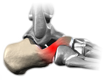 Clínica e Cirurgia do Pé e Tornozelo: Coalizão Tarsal