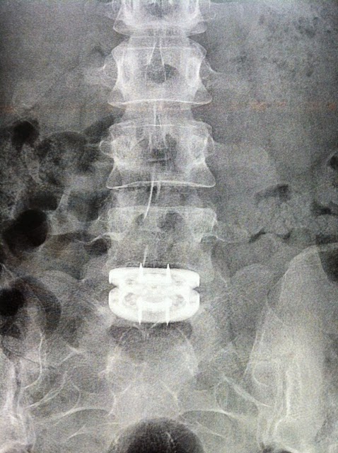 MI PRÓTESIS DE DISCO LUMBAR M6: RADIOGRAFIAS