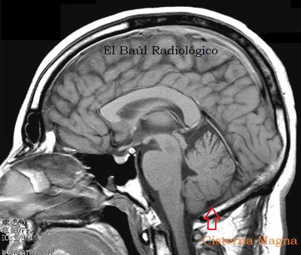 El Baúl Radiológico: ASPECTO DE LA CISTERNA MAGNA EN TOMOGRAFÍA ...