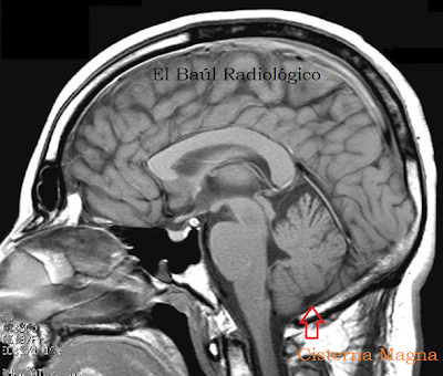 El Baúl Radiológico: ASPECTO DE LA CISTERNA MAGNA EN TOMOGRAFÍA ...