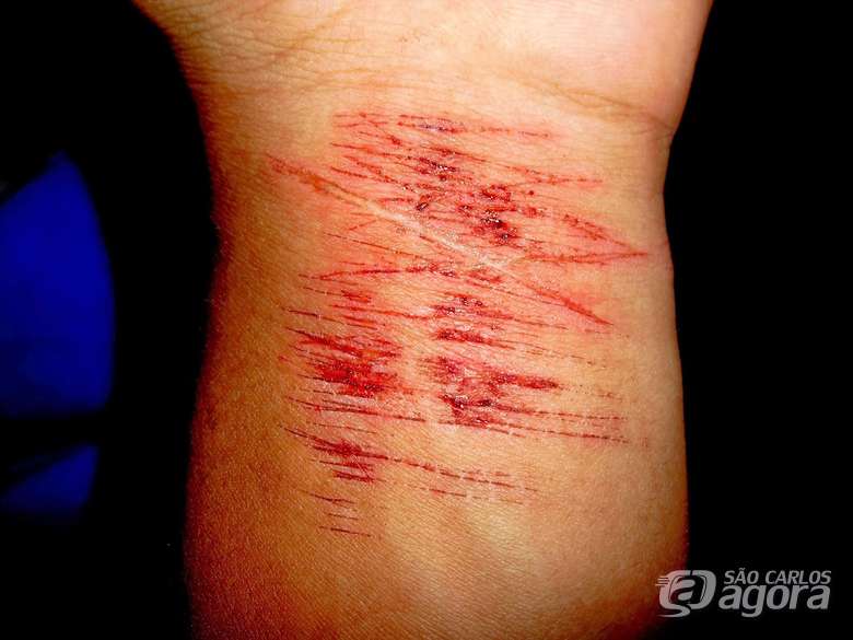 Automutilação de adolescente: um problema que preocupa