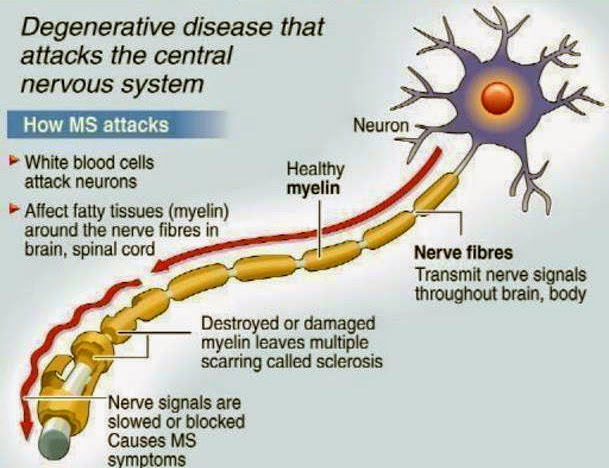 A Moment With Dr. Jim: The Different Types of Multiple Sclerosis