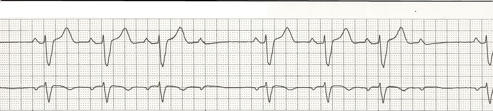 ACLS Rhythms: Heart blocks