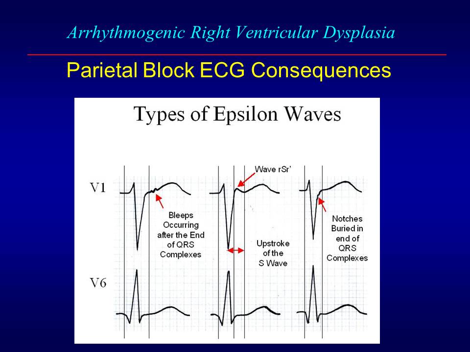 ARVCsGF: Advances in ARVD ECG interpretation
