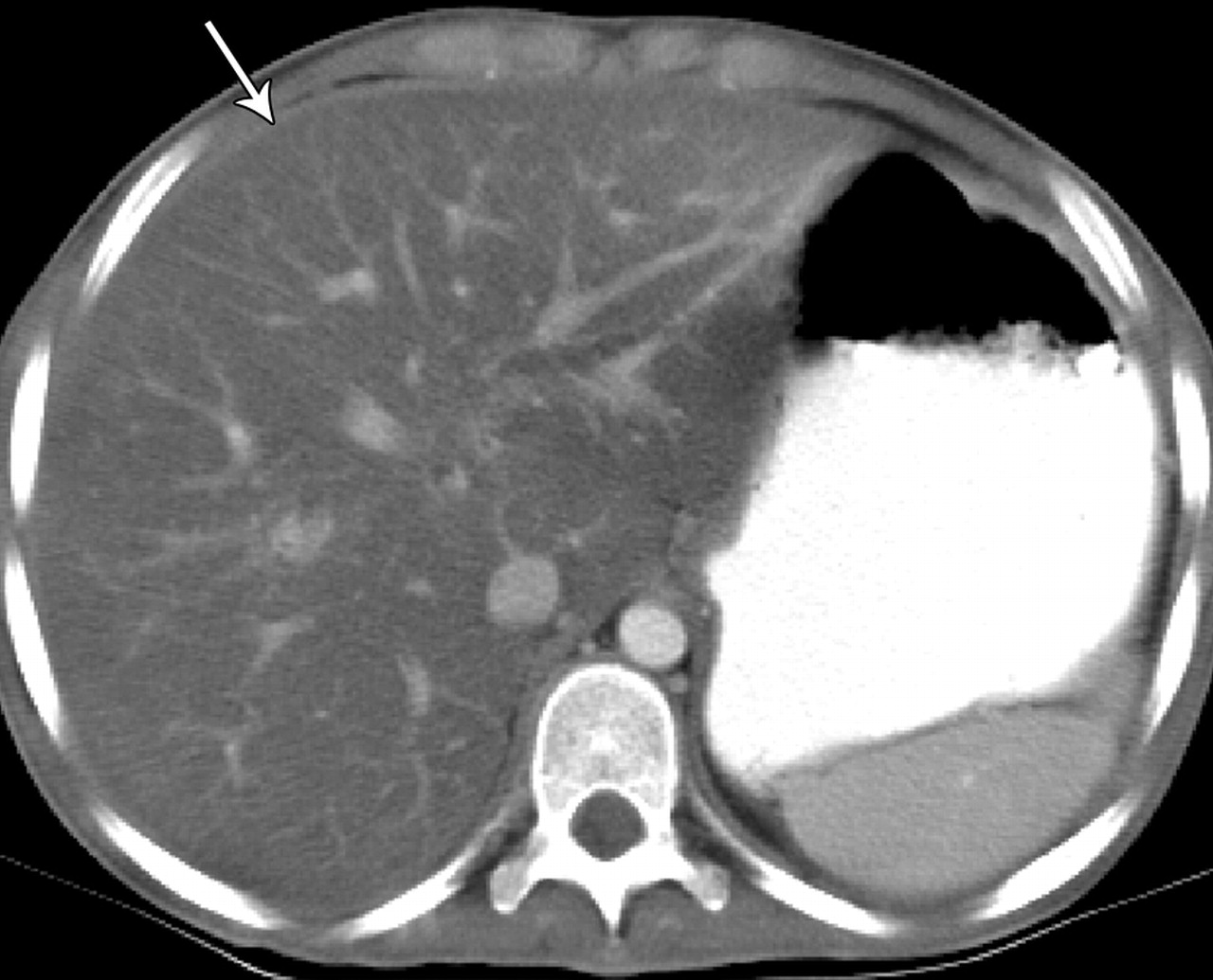 Tips Para Sa Mga Taong May Fatty Infiltration Sa Liver