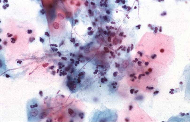 Citomed Citologia: ESFREGAÇOS INFECCIOSOS - CANDIDA