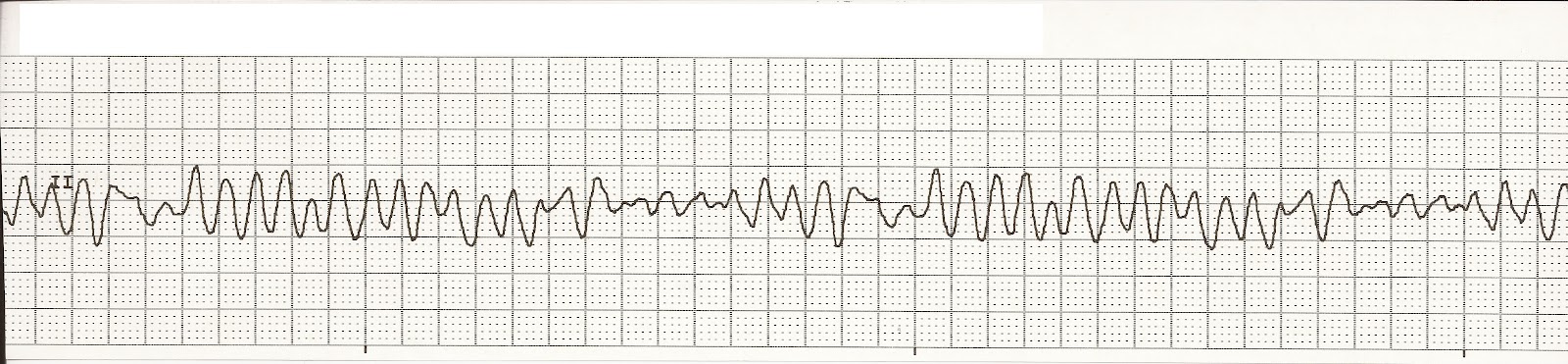 ACLS review: Pulseless VF/VT Part 1