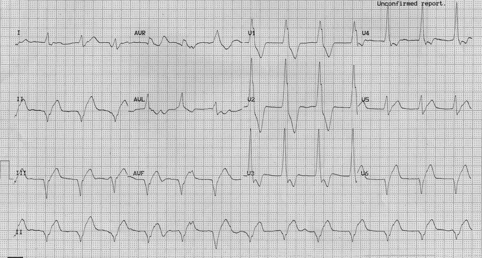 Idioventricular Rhythm | INA - ECG