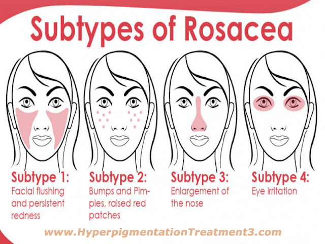 The Wardrobe Clinic: Rosacea & The types
