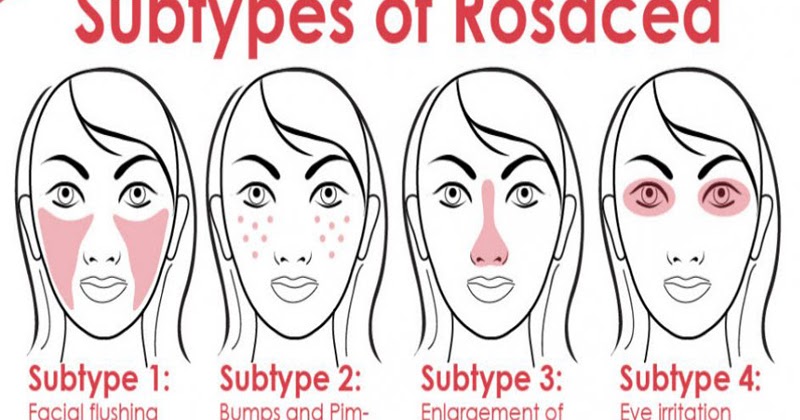 The Wardrobe Clinic: Rosacea & The types