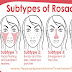 The Wardrobe Clinic: Rosacea & The types