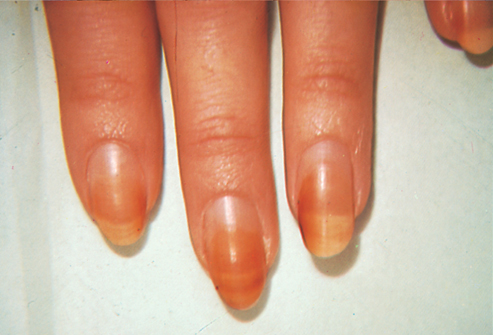 Common Nail Problems