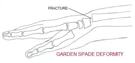 Eponymous fractures of Upper limb