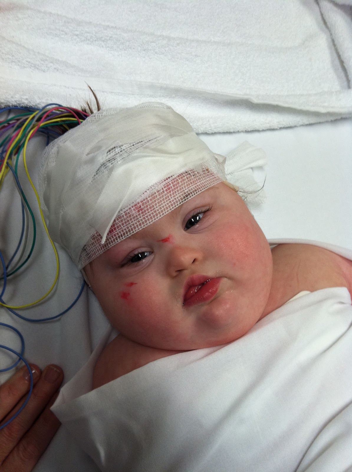 Wilson Family Blog: Infantile Spasms (West Syndrome) - SOLDIER