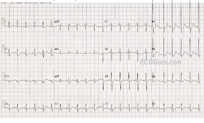 ECG Interpretation: ECG Interpretation Review #72 (Sinus Tachycardia in ...