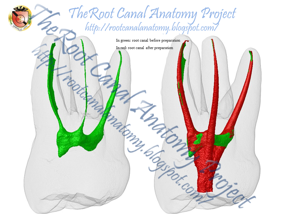 The Root Canal Anatomy Project: Conservative Endodontic Access ...