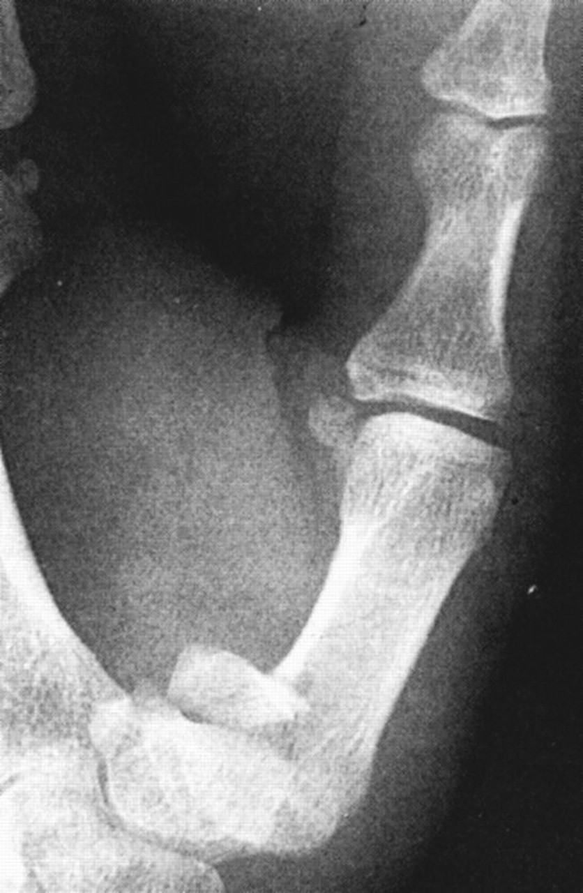 HAND SPLINTS: Thumb fractures - Eurohand2011 - Oslo (Norway)