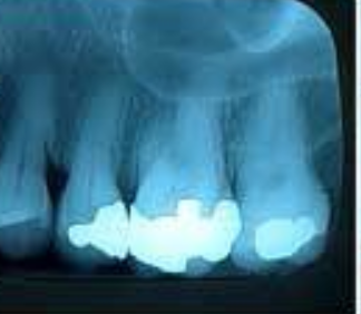 Info if you have silver/black fillings without Symptoms