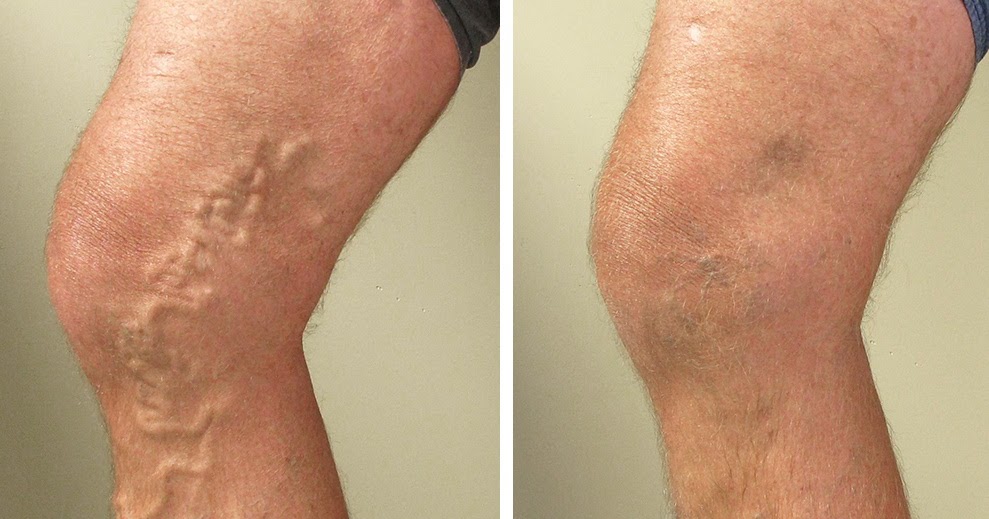 Les varices ~ Sport et Santé