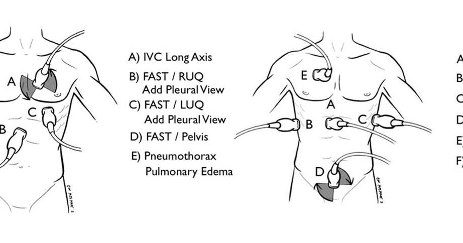 松下 ER ランチ・カンファレンス: POCUS・FAST・RUSH