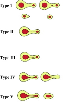 Anatomy MB2 first molar - Bauer Smiles