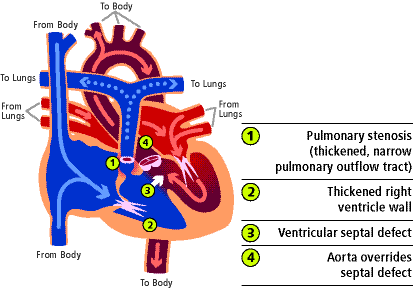 Tetralogy of Fallot ~ Cardiovascular Nurse