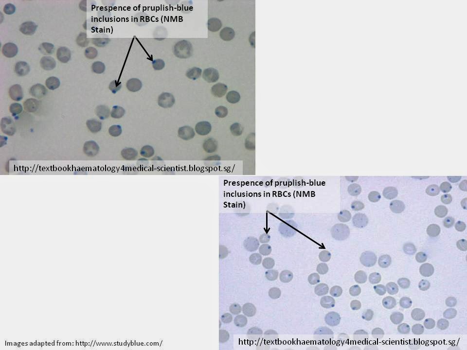 Haematology in a NutShell: Heinz Bodies