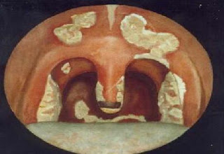 Gejala Difteri & Pengobatan