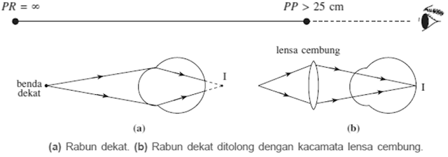 Cacat mata (kelainan mata) - FISIKA-OK3