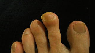 RANDOM THOUGHTS: Deformed toes