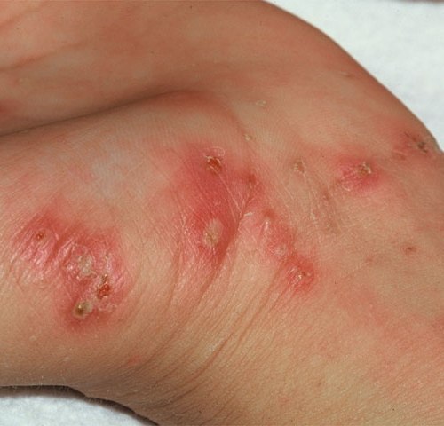 Microbial Diseases of the Nervous System: Bacterial Diseases of the ...