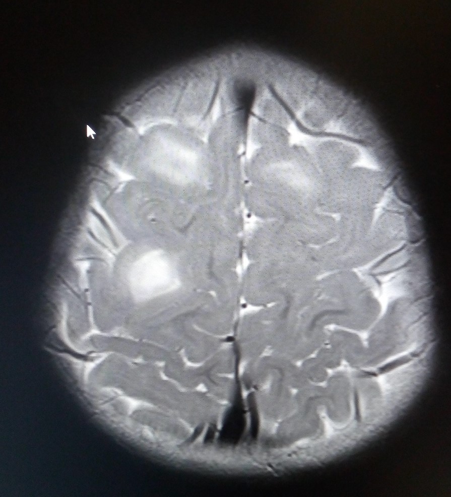 Tuberous Sclerosis : Case Report - Sumer's Radiology Blog