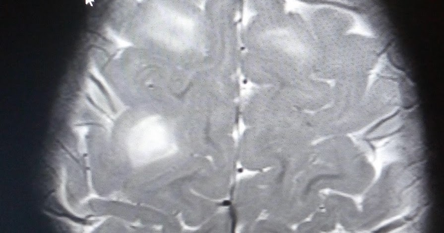 Tuberous Sclerosis : Case Report - Sumer's Radiology Blog