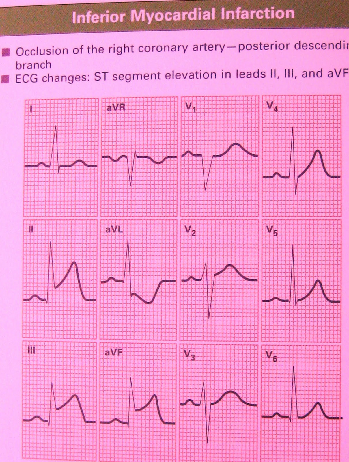 How to read ECG: LOCATION OF MI BY ECG LEADS