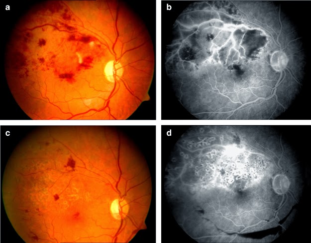 Medical Treatment Pictures-for Better Understanding: Retinal Laser ...