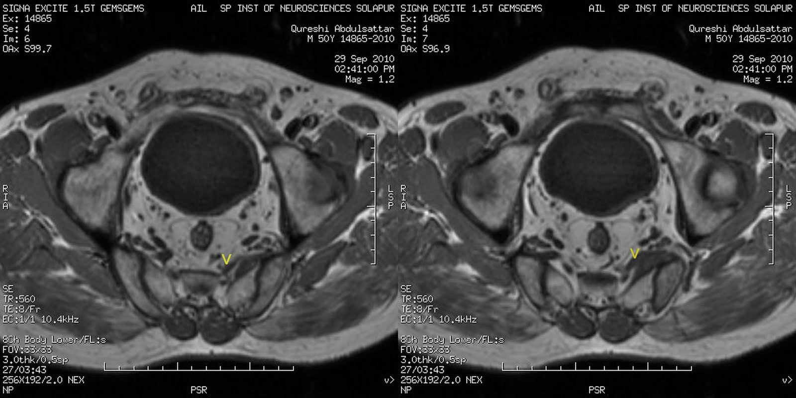 Dr Balaji Anvekar's Neuroradiology Cases: Pyriformis syndrome MRI